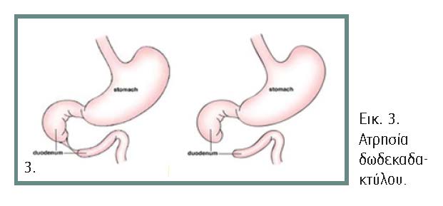 Ατρησίες εντέρου - hygeia.gr
